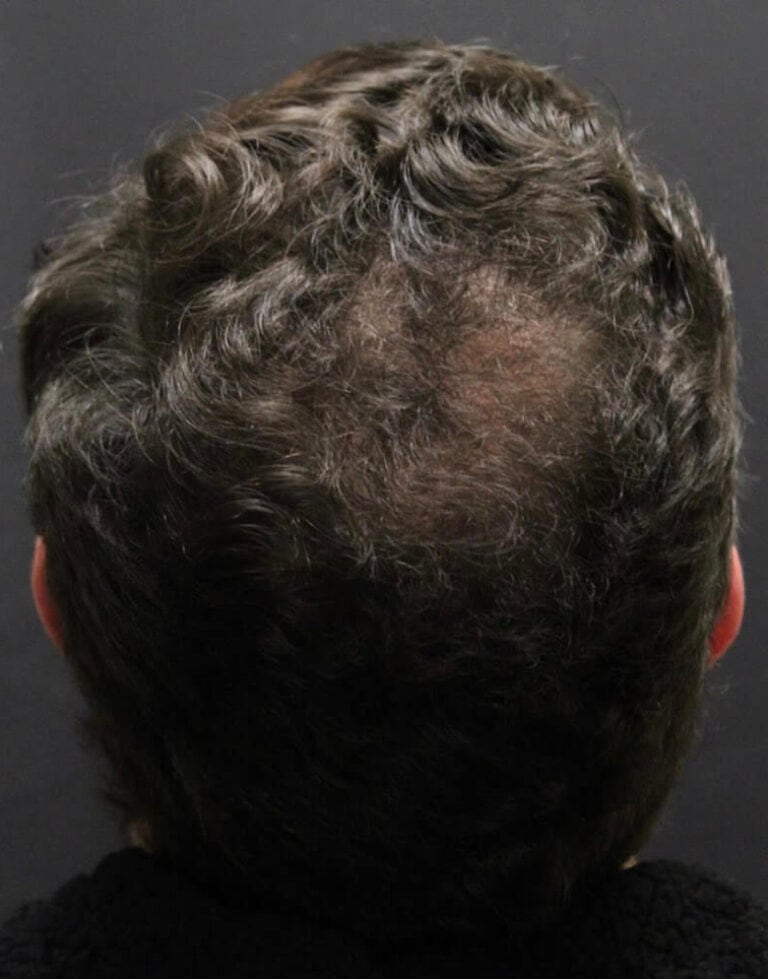 TED Hair Restoration - The Dermatology Clinic