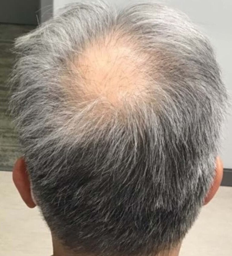 TED Hair Restoration - The Dermatology Clinic