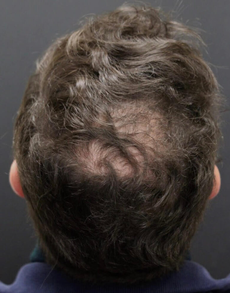 TED Hair Restoration - The Dermatology Clinic